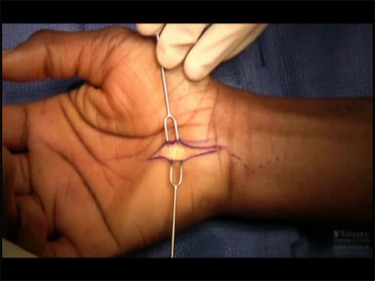 Video Gallery : Plastic and Reconstructive Surgery