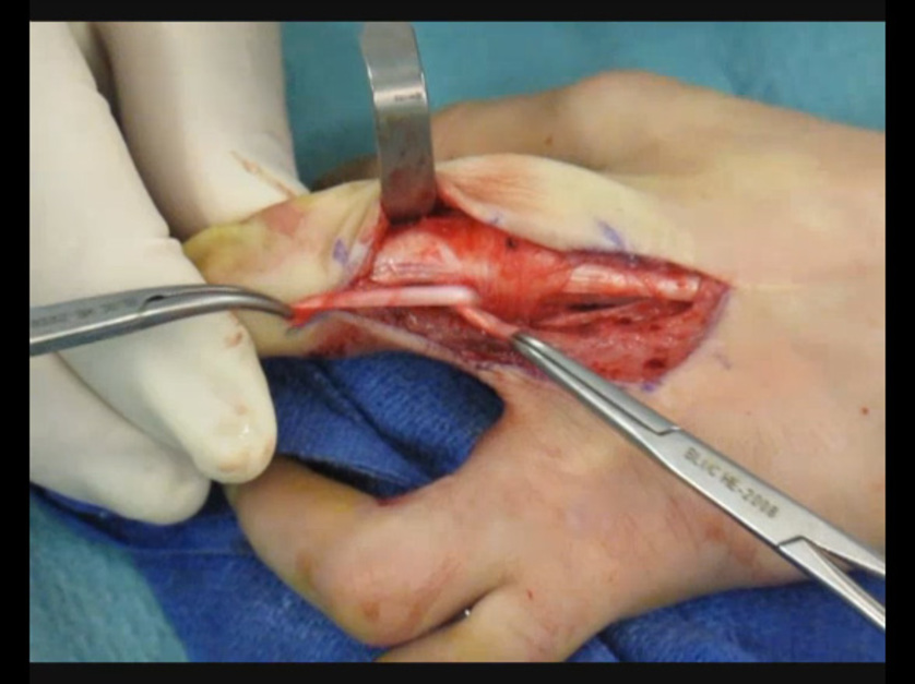 Techniques in Hand & Upper Extremity Surgery