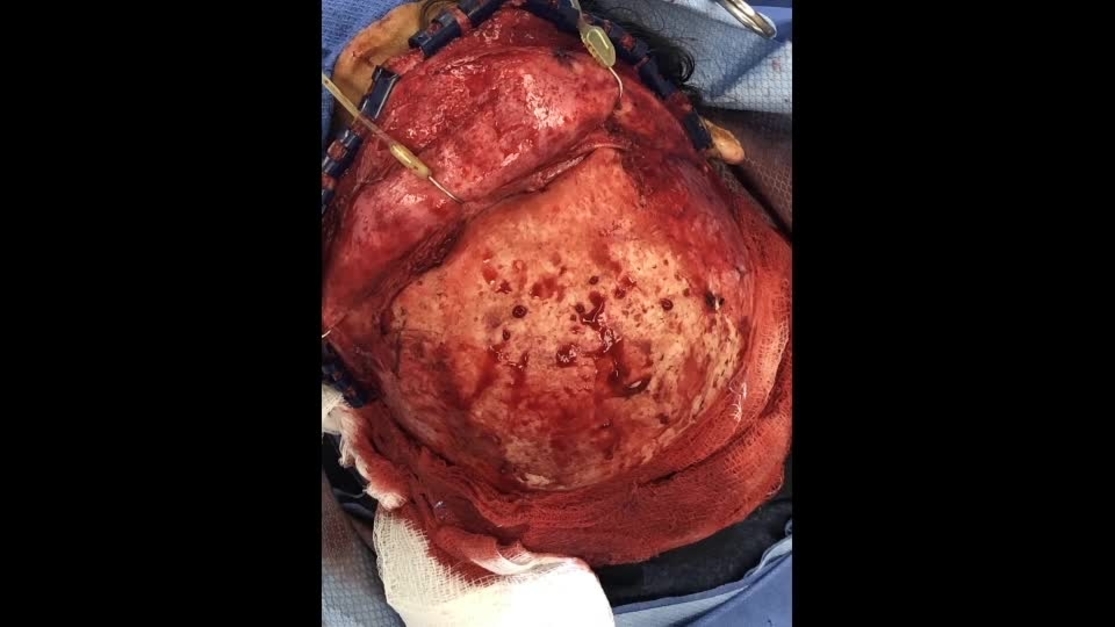 Plastic and Reconstructive Surgery – Global Open