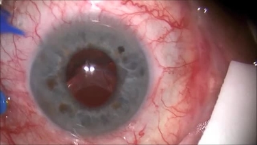 Video Gallery : RETINA