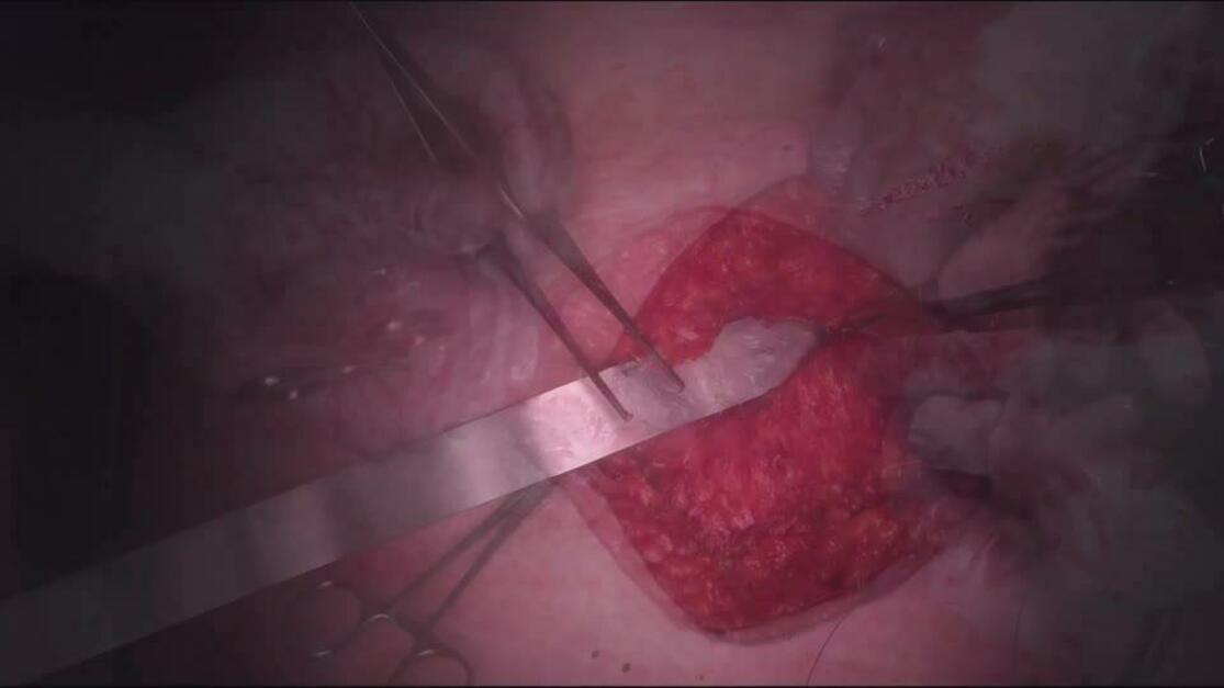 Plastic and Reconstructive Surgery – Global Open