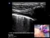 Video Gallery : Anesthesia & Analgesia