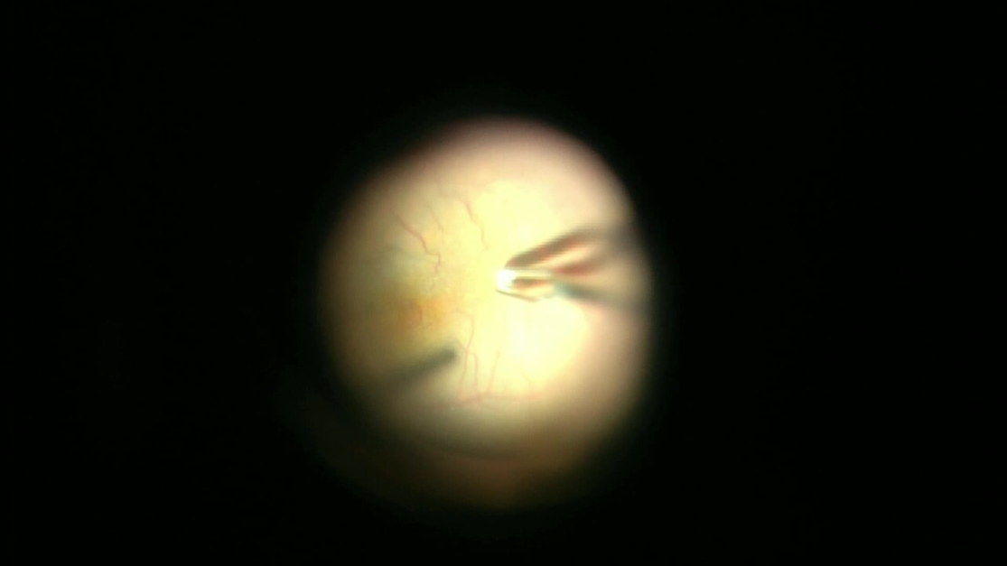 RETINA