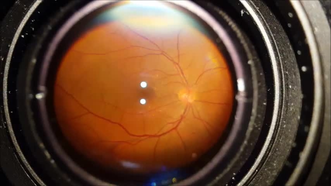 RETINA
