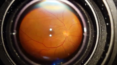 Video Gallery : RETINA