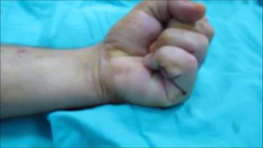 Video Gallery : Plastic and Reconstructive Surgery – Global Open