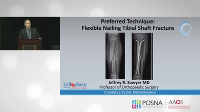Flexible IM Rods for Tibial Shaft Fracture - POSNAcademy