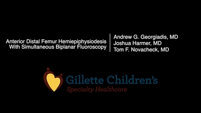 Percutaneous Anterior Distal Femoral Hemiepiphysiodesis Using ...