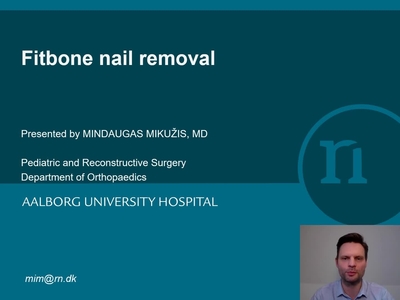 Fitbone Nail Removal Technique - POSNAcademy
