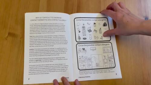 Eczema Chemical Sensitivity Rash Allergic Contact Dermatitis Allergy ...