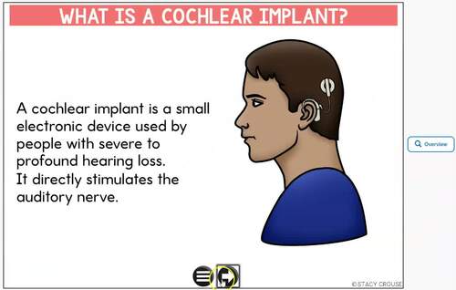 Deaf Education Self Advocacy Hearing Loss Devices Cochlear Implant Boom ...