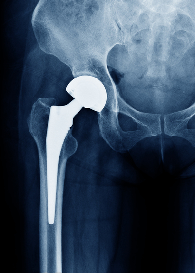 How to Take Care of Your Joint Replacement - HSC MediaSpace